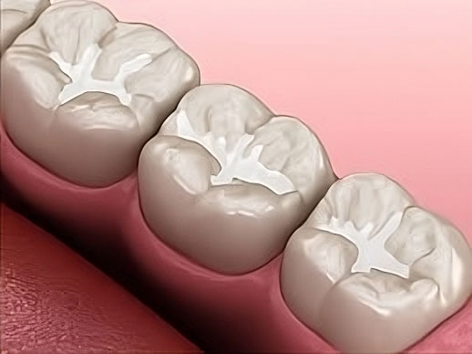 Fissure Sealants - Kids Dental